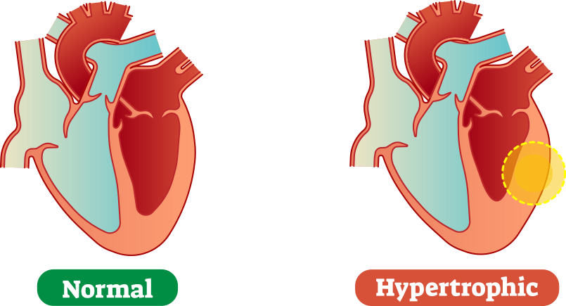 Cardiac Tissue Engineering and Gene Therapy Approaches for Hypertrophic ...